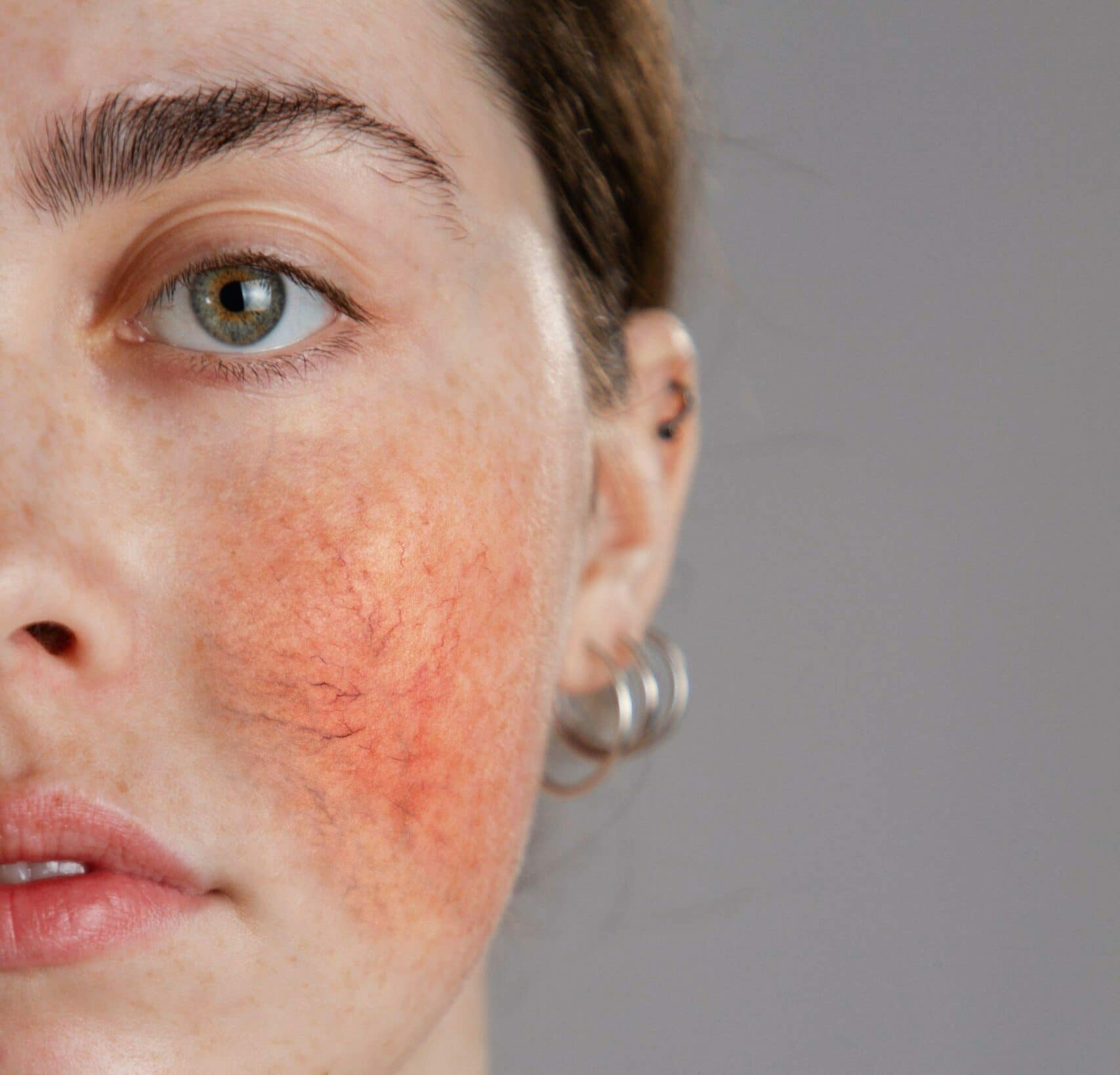 What Is Rosacea And How Can It Be Treated? - Sustain Health Magazine